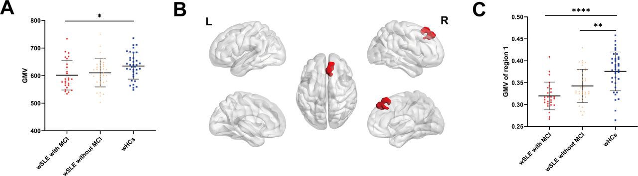 Cortical changes in women with systemic lupus erythematosus with mild cognitive impairment: a ...