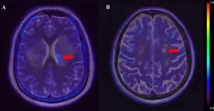 TSPO PET/MR in neuropsychiatric lupus: neuroinflammatory metabolic ...